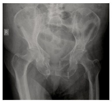 The Bind About Pelvic Binders (Part 2) – Prehospital and Retrieval ...
