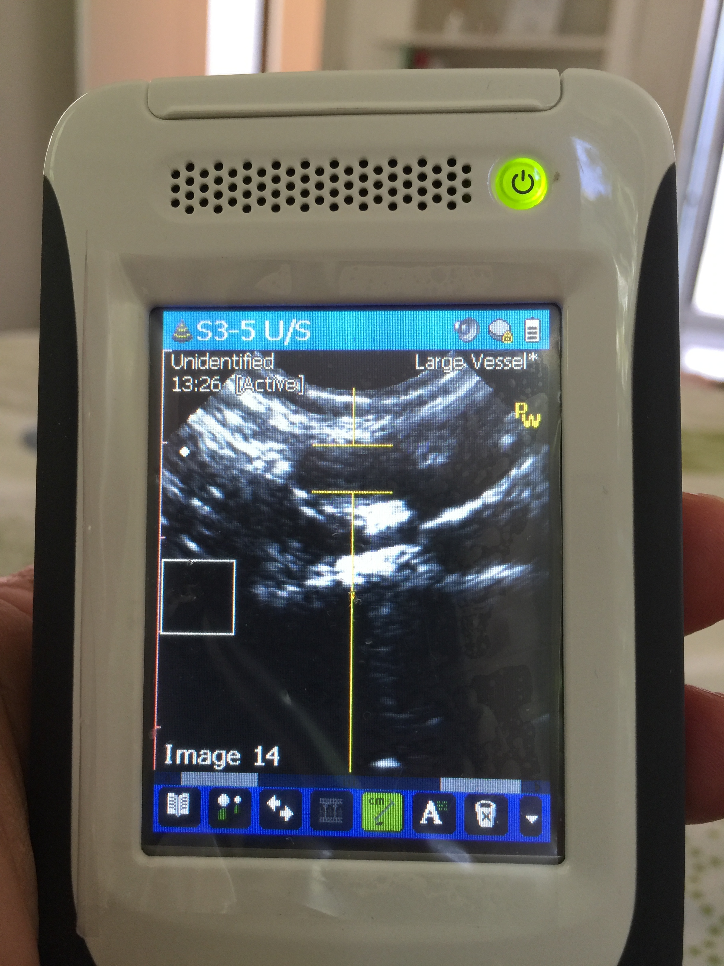 Signostics RT handheld ultrasound review – Prehospital and Retrieval ...